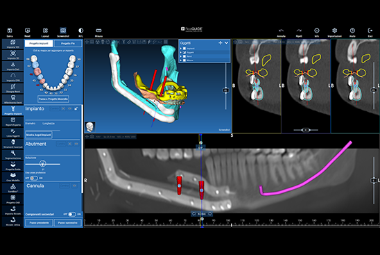 Oxy Implant Digitizes Implantation Process with DentaJet 3D Printing Solutions