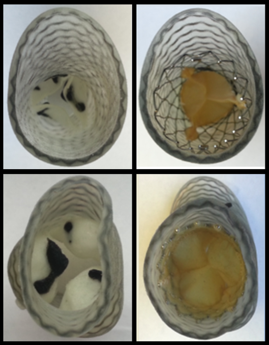 3D Printed Heart Valves Assist in Planning Patient Specific Surgeries