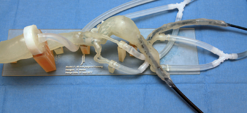 3D Printed Models For Complex Procedures